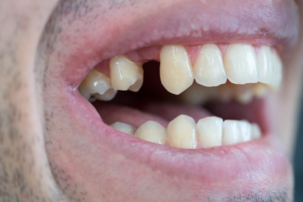 Sore or swollen gums | William J. Claiborne, DDS MS