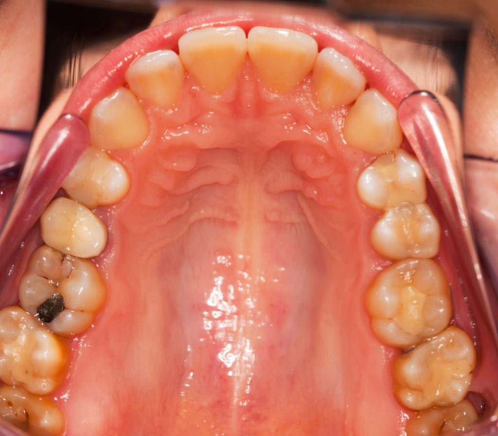 A Spot In The Mouth May Resolve On Its Own, Or Not. Know When To React ...