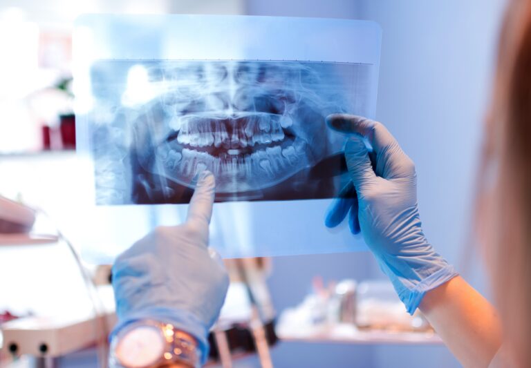 Tooth Loss Cause of Shrinking Face, Sunken-In Mouth | William J ...