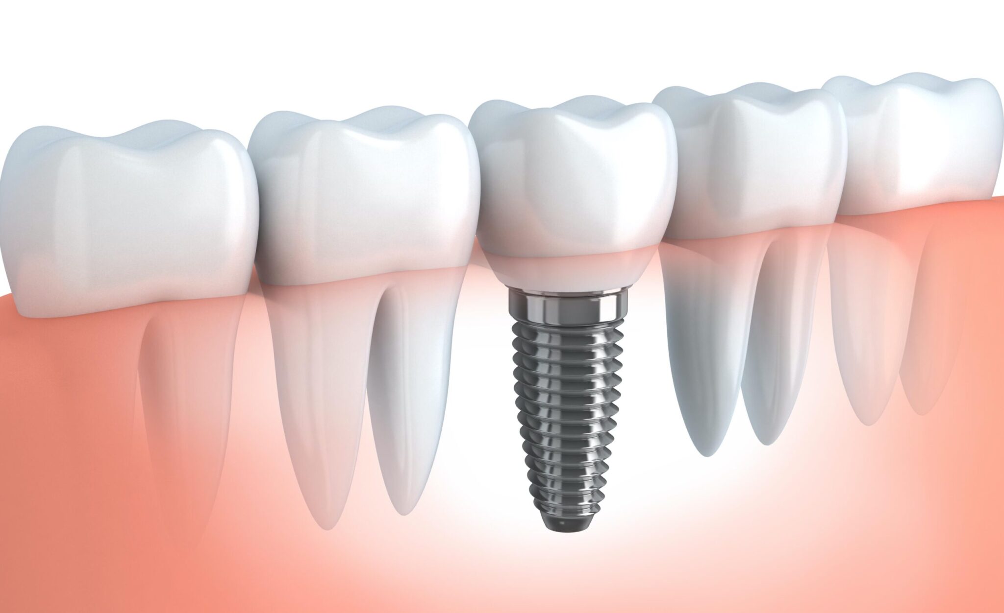The Mirror Image Of Dental Implants | William J. Claiborne, DDS MS