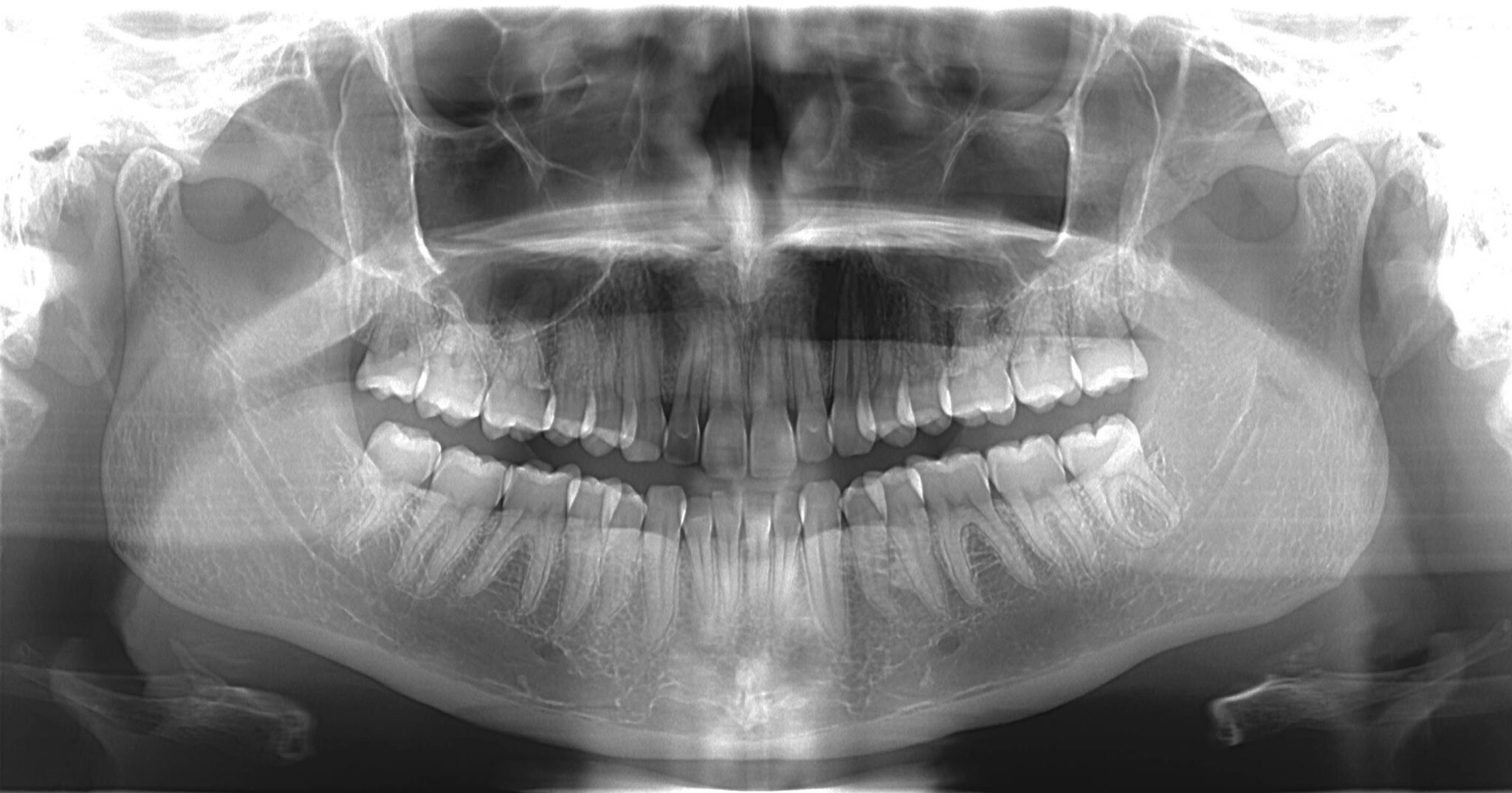 3D Dental Cone Beam CT Scans and 2D OPG (Orthopantomagram), Dental X ...