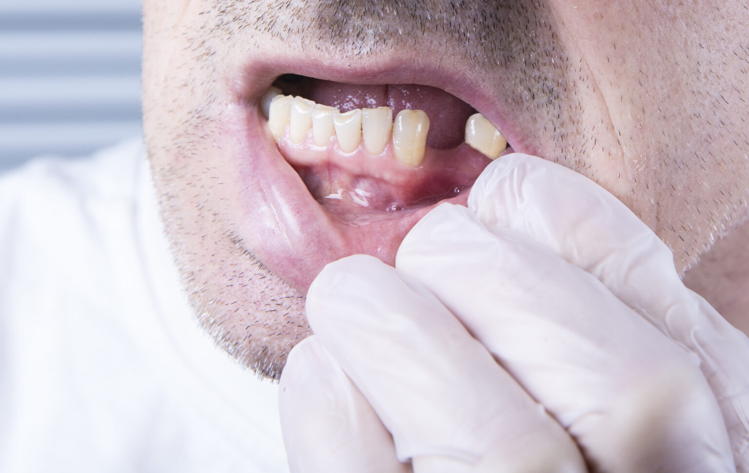 Tooth Loss | William J. Claiborne, DDS MS